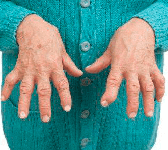 Flexum Gel - comentarios - opiniões - funciona - preço - onde comprar ...